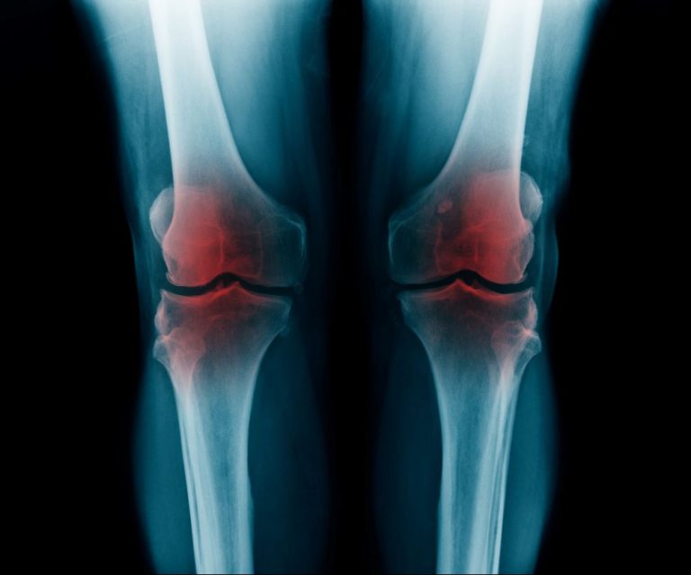 Genoux Valgum : que faire ? | Causes, symptômes et traitements